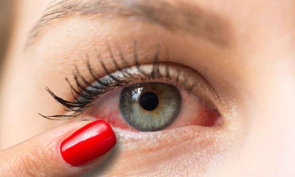 How To Get Rid Of Red Veins In Eyes - Pure Optical